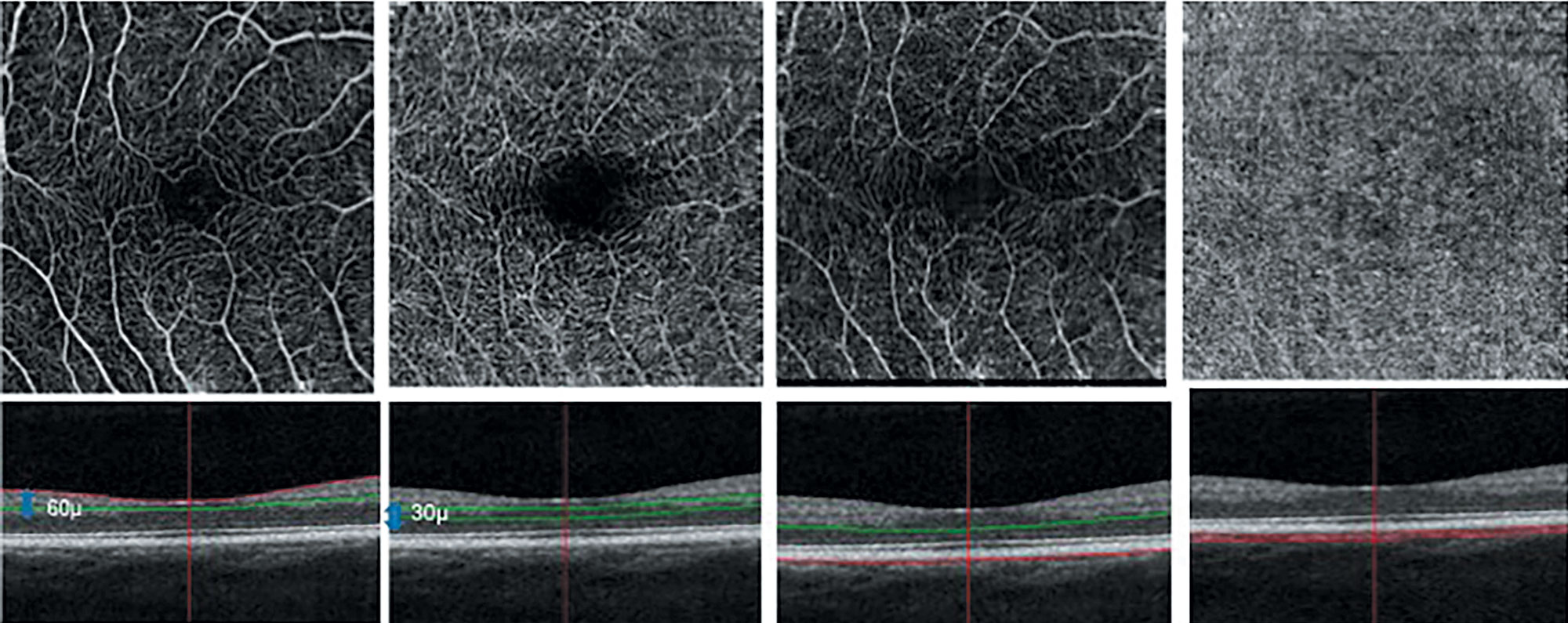 Angiographie-OCT en pratique clinique : un formidable outil ...
