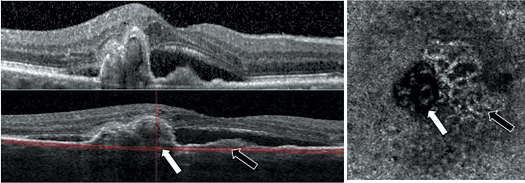 Angiographie-OCT en pratique clinique : un formidable outil ...