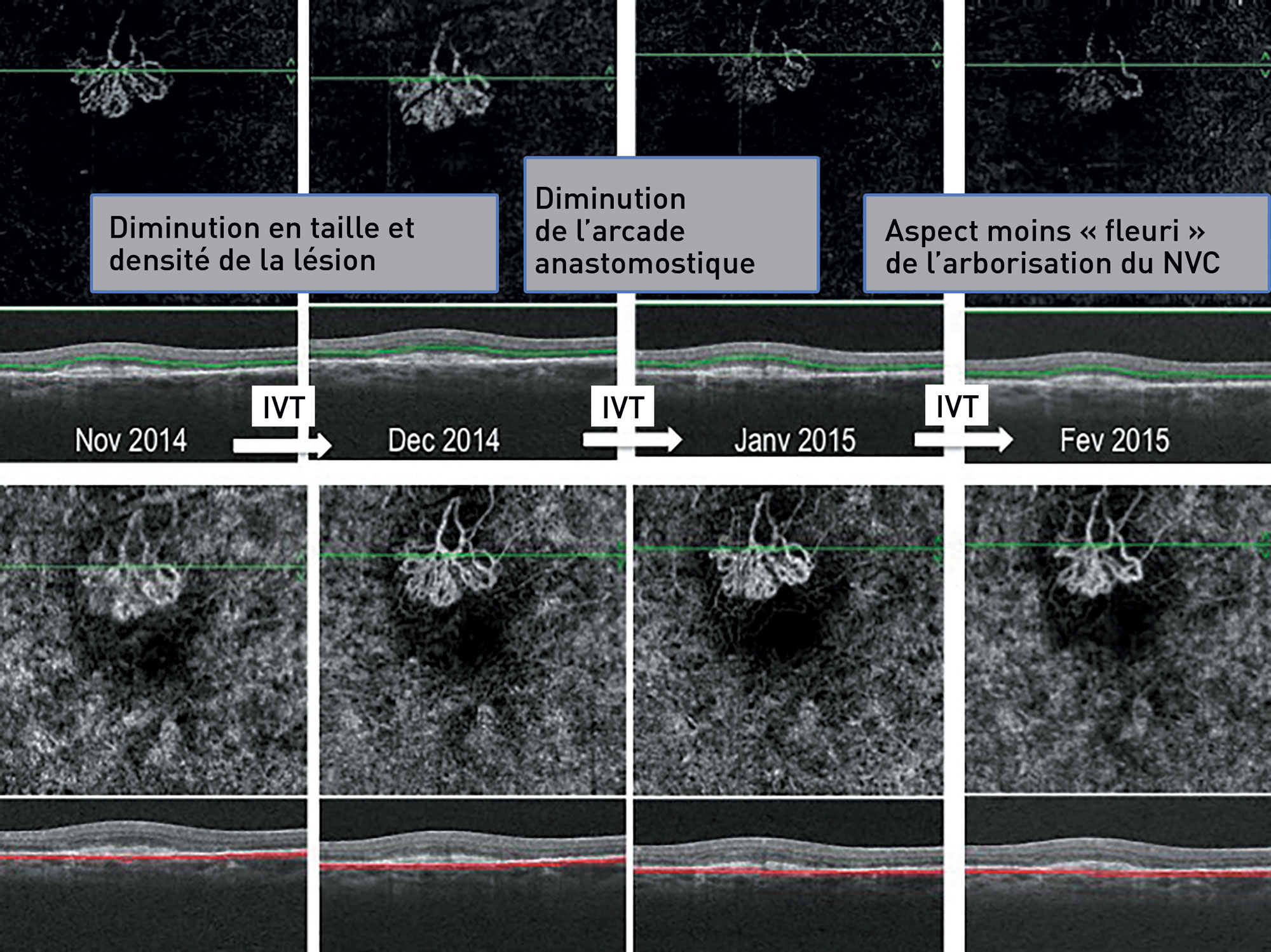 Angiographie-OCT en pratique clinique : un formidable outil ...