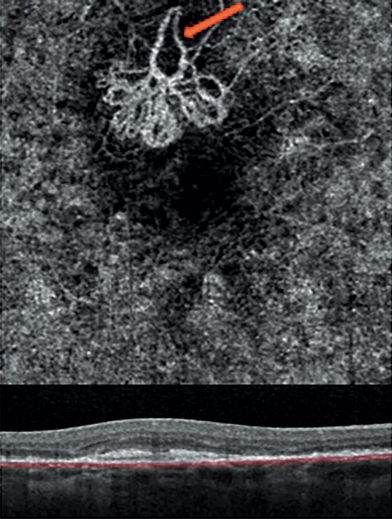 Angiographie-OCT en pratique clinique : un formidable outil ...