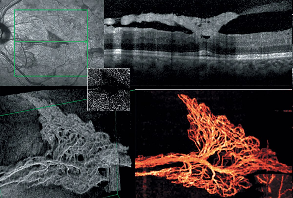Angiographie-OCT en pratique clinique : un formidable outil ...