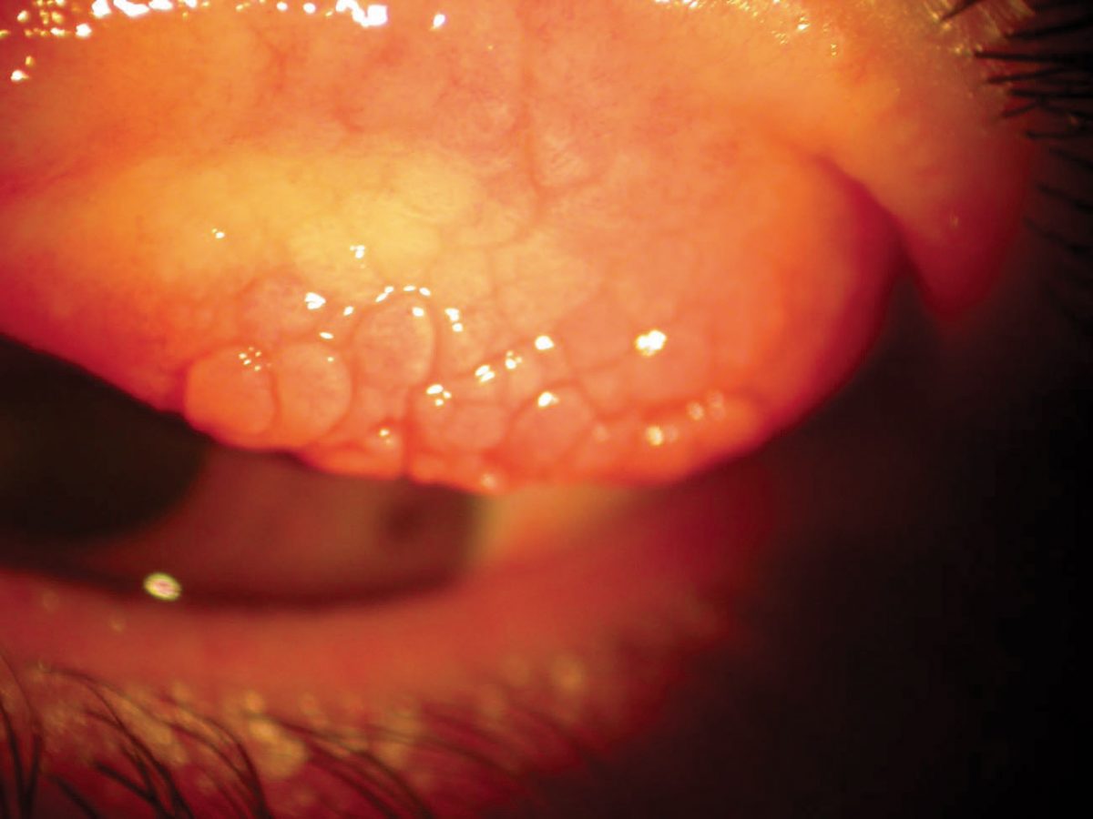Ciclosporine en collyre dans les pathologies de la surface oculaire ...