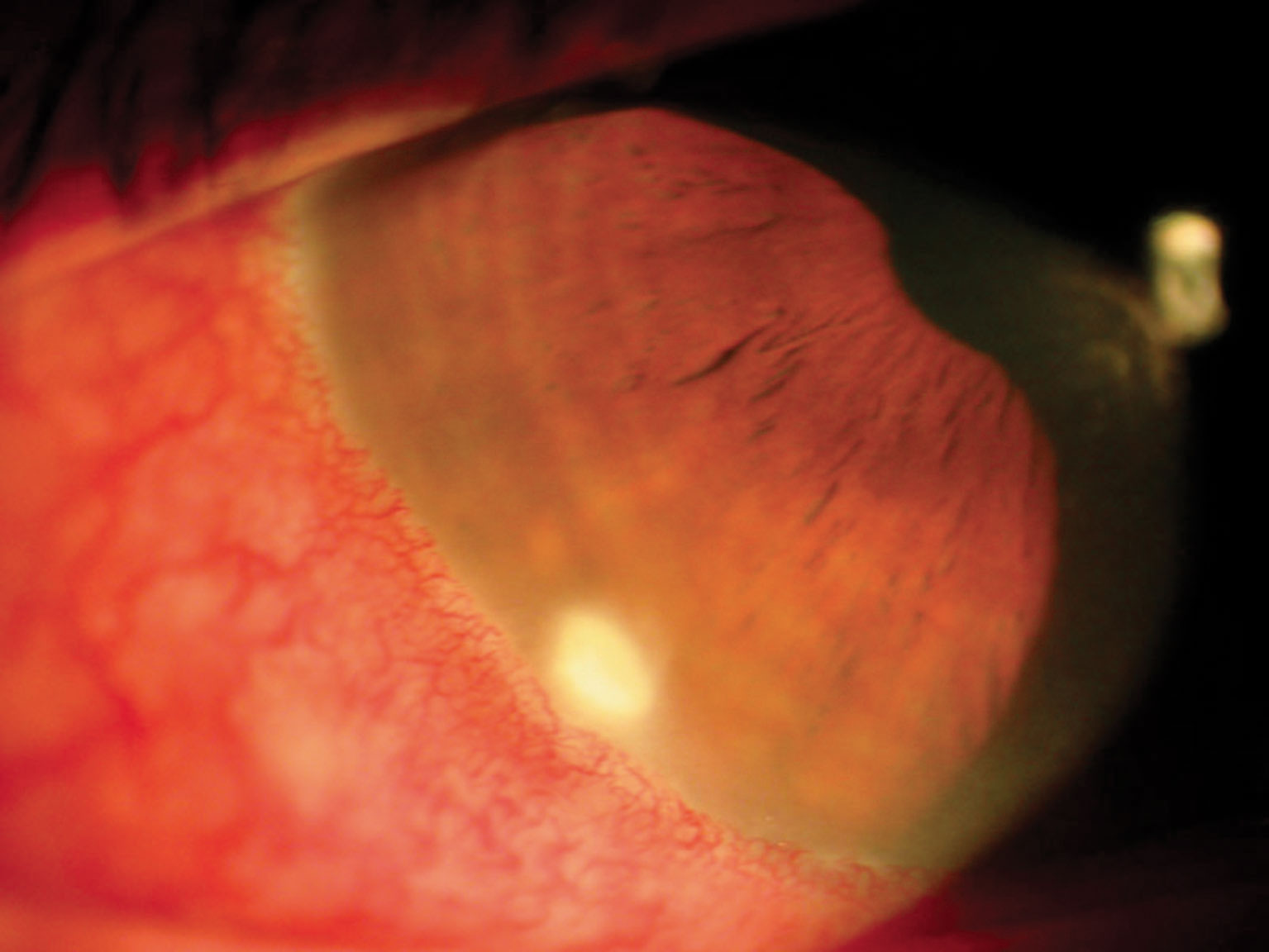 Ciclosporine en collyre dans les pathologies de la surface oculaire ...