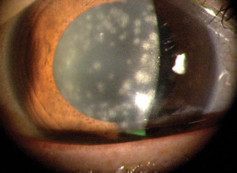 Ciclosporine en collyre dans les pathologies de la surface oculaire ...