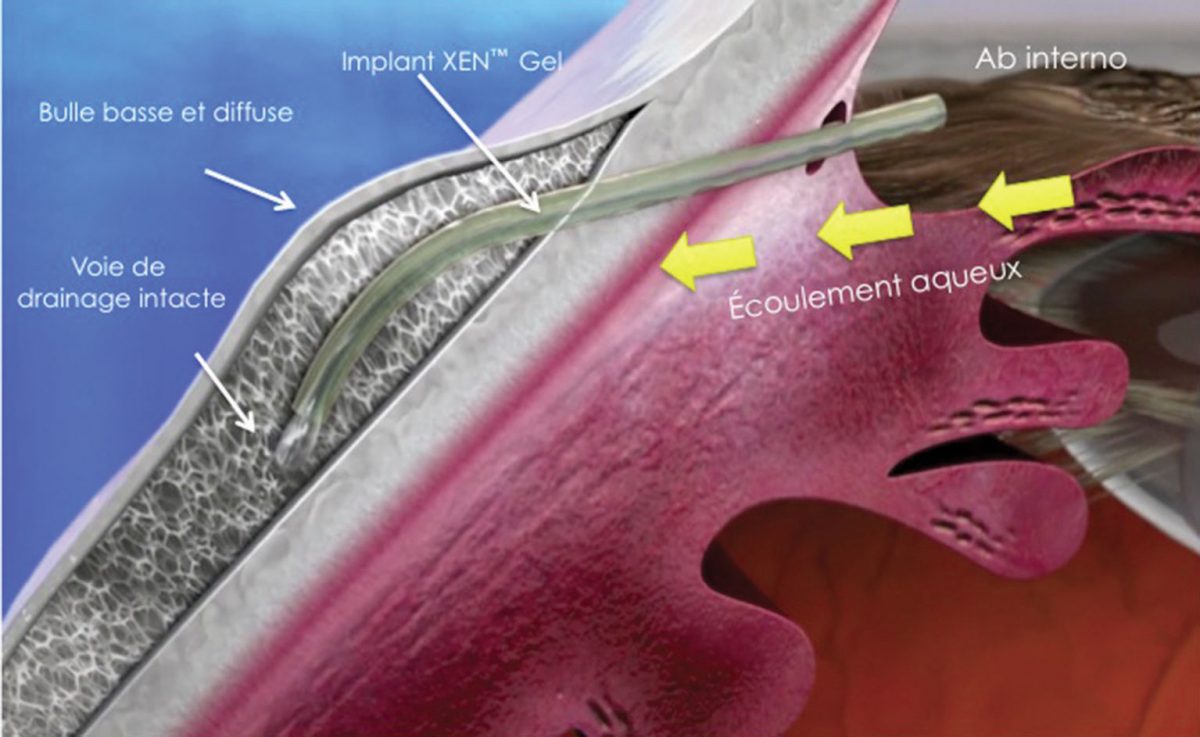 Chirurgies mini-invasives du glaucome : le début d’une nouvelle ère ...
