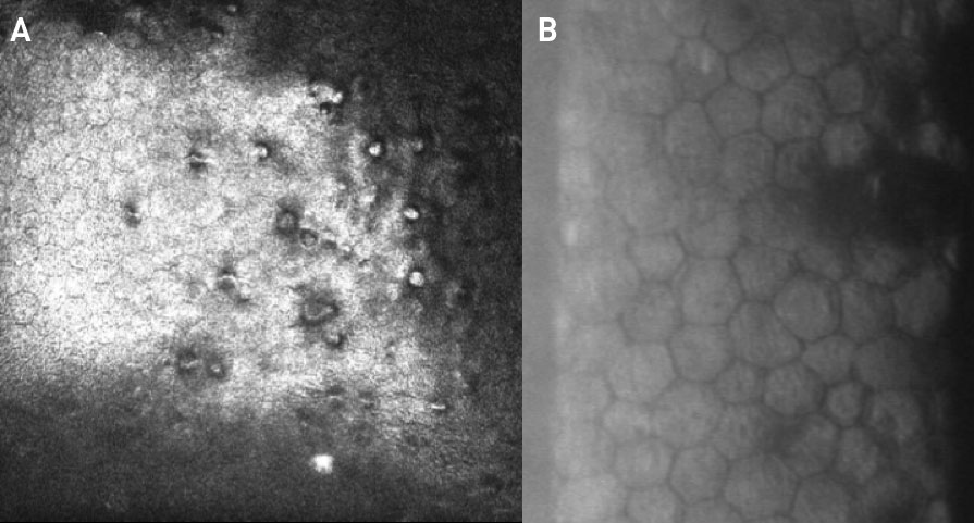 Sémiologie de la dystrophie endothéliale de Fuchs et microscopes ...