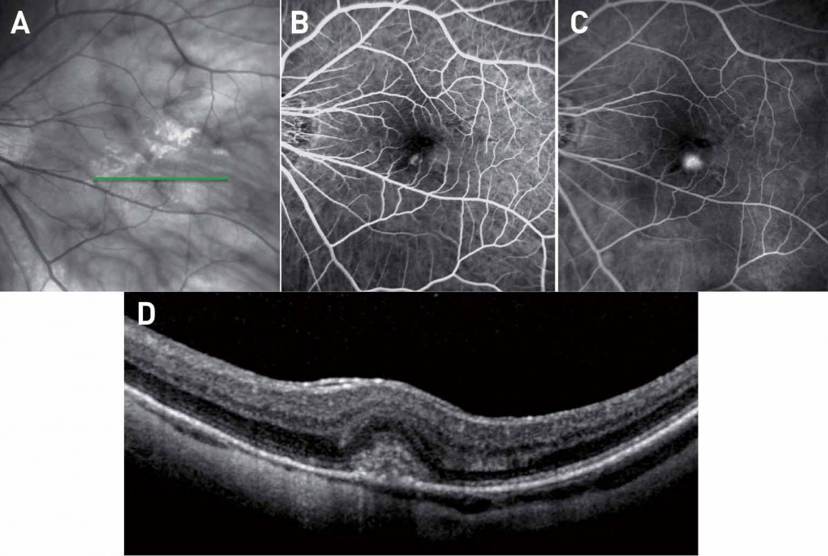 Les complications maculaires de la myopie forte : diagnostic et ...