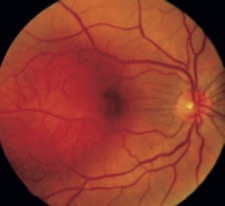 SFO 2020 : Tumeurs - Mon Oeil